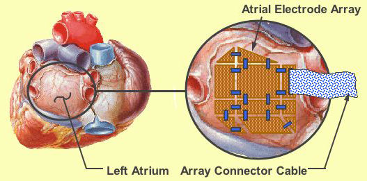 Atrial Wavefront Steering Using Low Energy Stimulation | BMIL